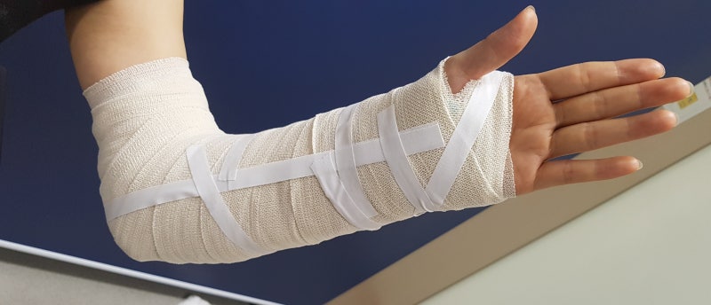 Sugar Tong Splint : 네이버 블로그