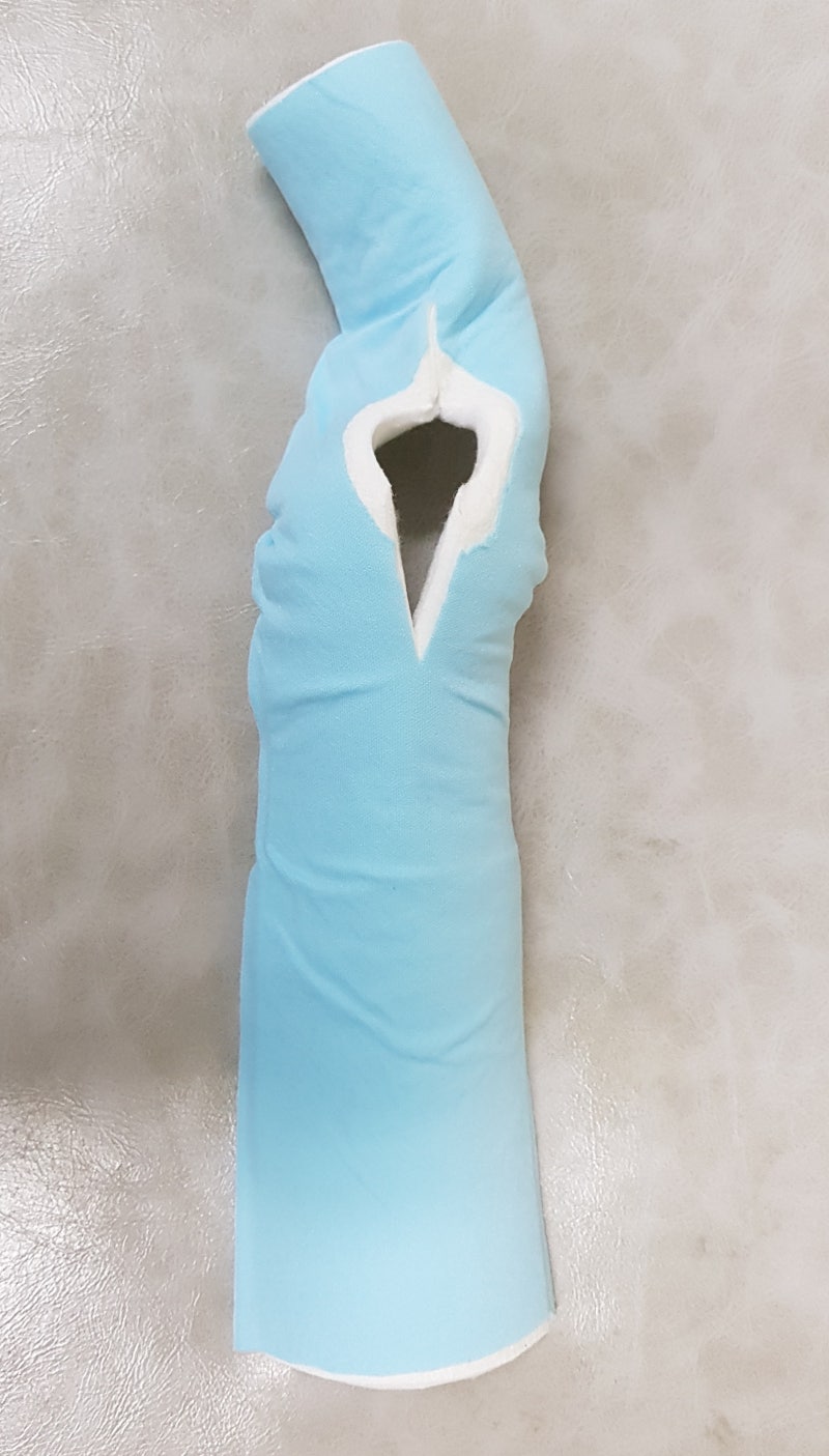 Short Arm Radial Gutter Splint : 네이버 블로그