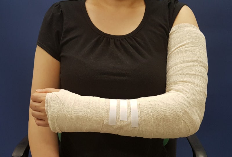 Long Arm Splint : 네이버 블로그