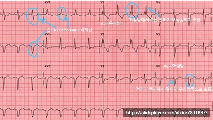 [미국의대생일상] 심전도 각차단 (RBBB vs LBBB) 쉽게 이해하기 : 네이버 블로그