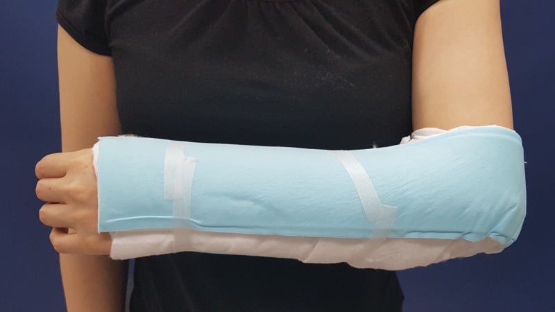 Sugar Tong Splint : 네이버 블로그