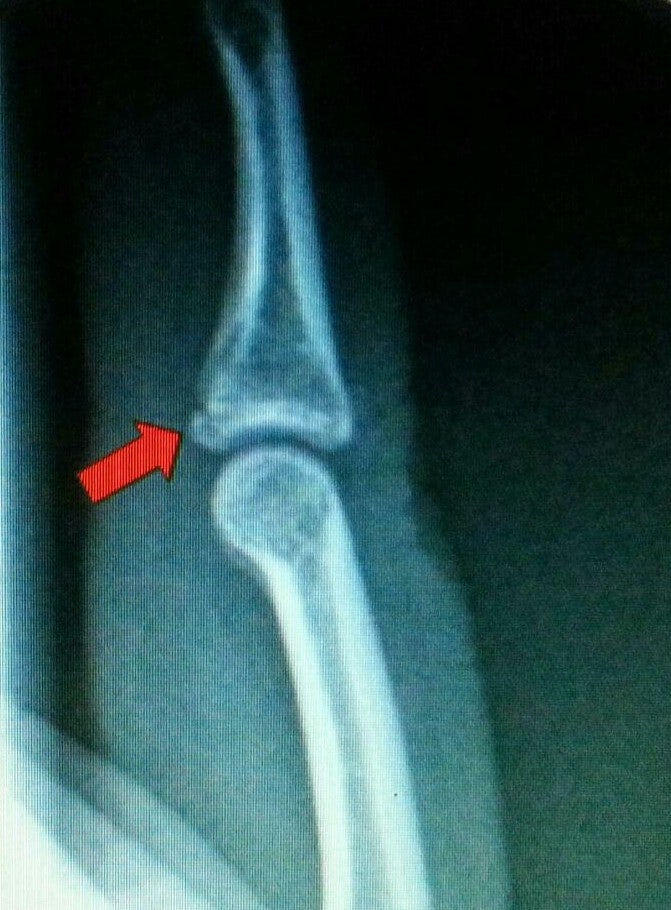 Short Arm Extension Block Splint : 네이버 블로그