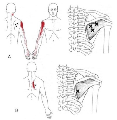 극하근(Infraspinatus)의 통증 유발점(Trigger Point)의 기전과 치료 : 네이버 블로그