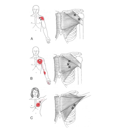 대흉근(Pectoralis major) 통증유발점(트리거포인트,trigger point)의 기전과 치료(Myofascial ...