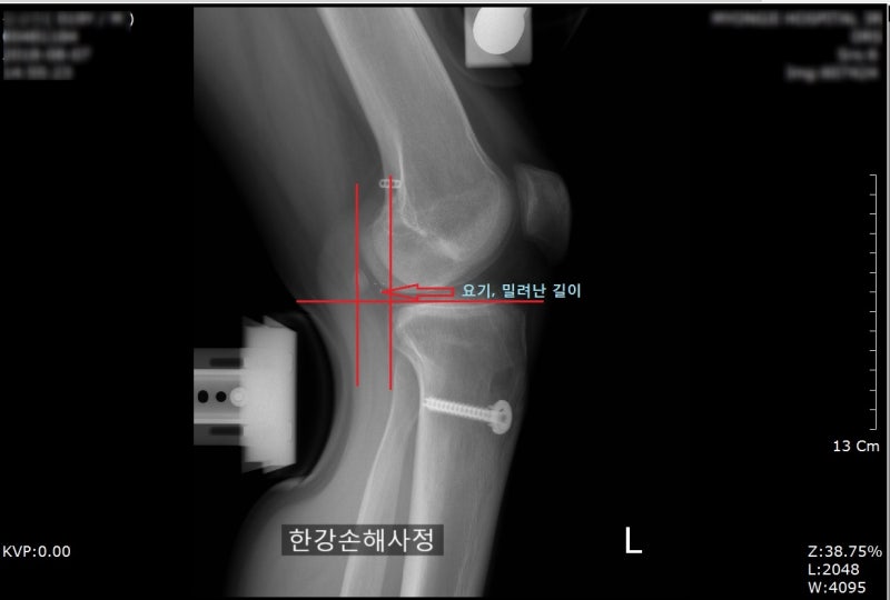 교통사고 전방십자인대파열 산재급수는 네이버 블로그