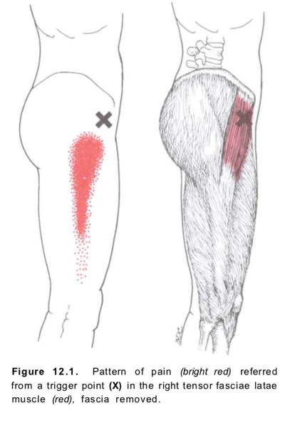 대퇴근막장근(Tensor Fascia lata, TFL)통증유발점(trigger point,근막통증증후근)의 기전과 치료 ...