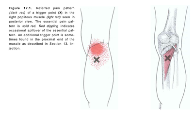 Popliteus (슬와근) 통증유발점(트리거포인트,trigger point)의 기전과 치료(Myofascial pain and ...