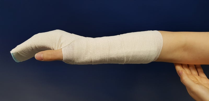Short Arm Splint : 네이버 블로그