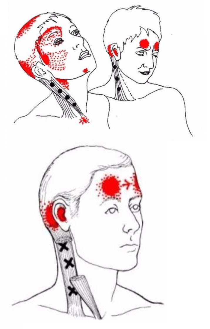 흉쇄유돌근sternocleidomastoid 목빗근 해부학 두통 눈이 침침할때 시력개선 거북목 라운드숄더 네이버 블로그