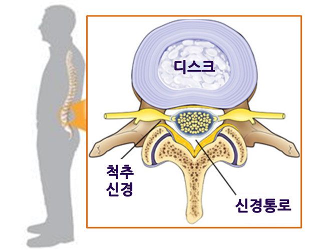 울산 허리병원 울들병원 척추관협착증 자가진단법 네이버 블로그