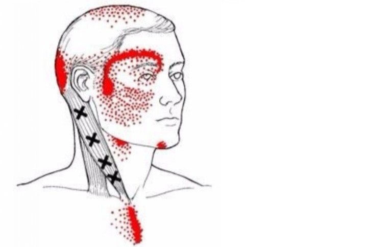 흉쇄유돌근sternocleidomastoid 목빗근 해부학 두통 눈이 침침할때 시력개선 거북목 라운드숄더 네이버 블로그