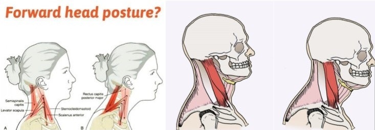 흉쇄유돌근sternocleidomastoid 목빗근 해부학 두통 눈이 침침할때 시력개선 거북목 라운드숄더 네이버 블로그