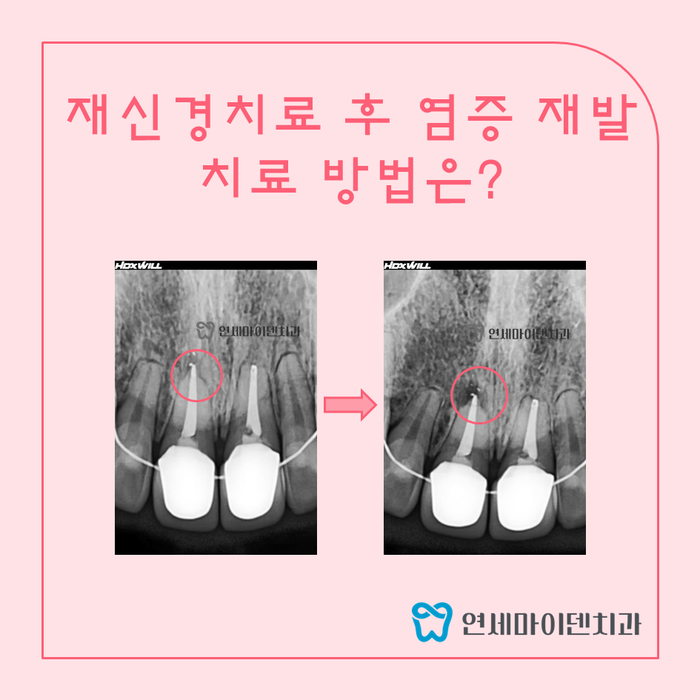 재신경치료 후 염증 재발 미세현미경 치근단절제술로 자연 치아 살리기 네이버 블로그