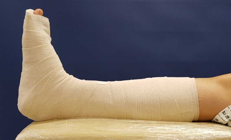 Short Leg Splint : 네이버 블로그