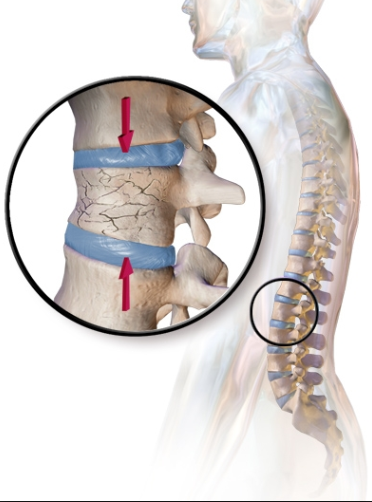 [흉추압박골절 T11폐쇄성골절] T11 compression fracture, 흉추11번 압박골절 후유장해 보상 : 네이버 블로그