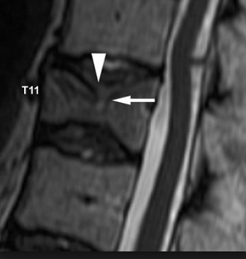 [흉추압박골절 T11폐쇄성골절] T11 compression fracture, 흉추11번 압박골절 후유장해 보상 : 네이버 블로그
