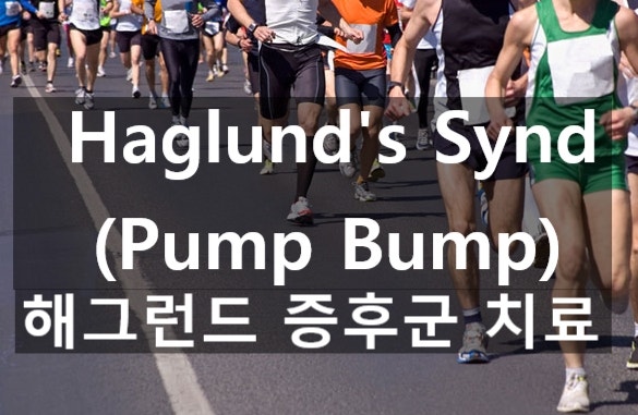 뒤꿈치가 튀어나왔어요 - 헤그란드 변형(Haglund deformity) : 네이버 블로그