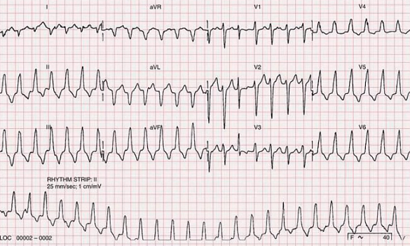 capture beat(포획박동)과 fusion beat(융합박동) : 네이버 블로그