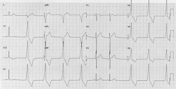 Accelerated idioventricular rhythm (AIVR): 재관류(reperfusion) 증거 : 네이버 블로그