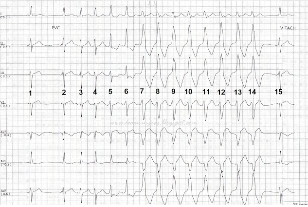 capture beat(포획박동)과 fusion beat(융합박동) : 네이버 블로그