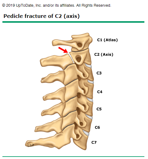 C2 pedicle fracture case (56/M) : 네이버 블로그