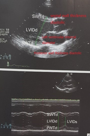 echocardiography- 좌심실 기능 측정 : 네이버 블로그