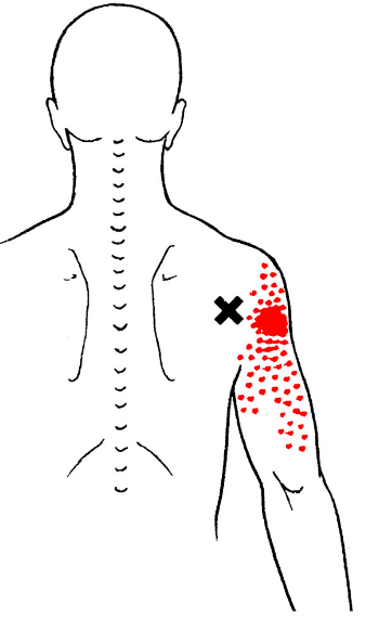 "운동시 팔저림의 원인" 소원근 트리거포인트 teres minor trigger point 『역삼PT 선릉역 체형교정 문현일 ...