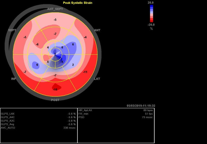 심근경색 (Myocardial infacrtion)LAD MI : 네이버 블로그