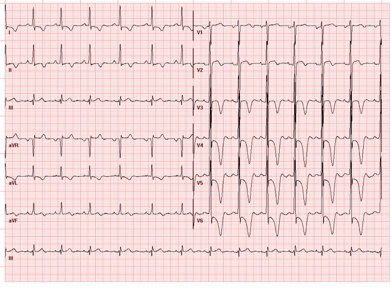 좌심실 비대, 심전도, Left ventricular hypertrophy(LVH), ECG(EKG) : 네이버 블로그