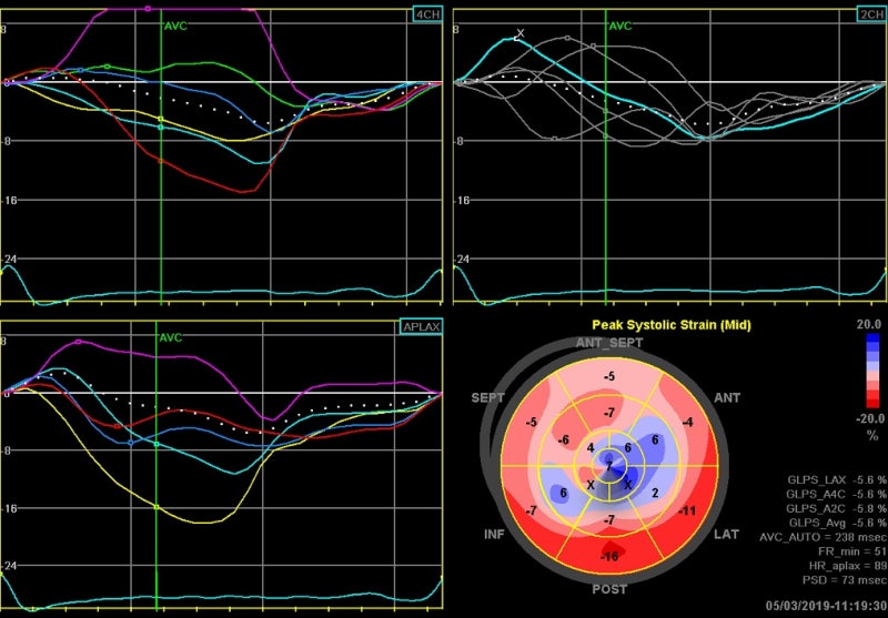 심근경색 (Myocardial infacrtion)LAD MI : 네이버 블로그
