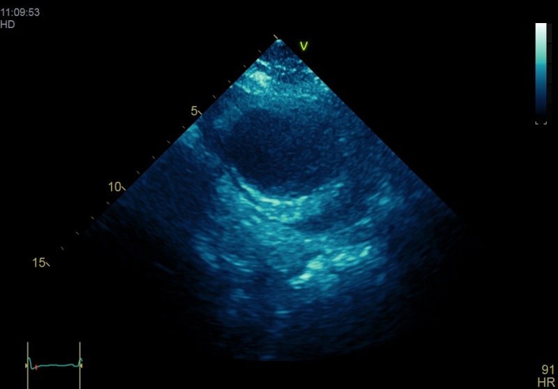 심근경색 (Myocardial infacrtion)LAD MI : 네이버 블로그