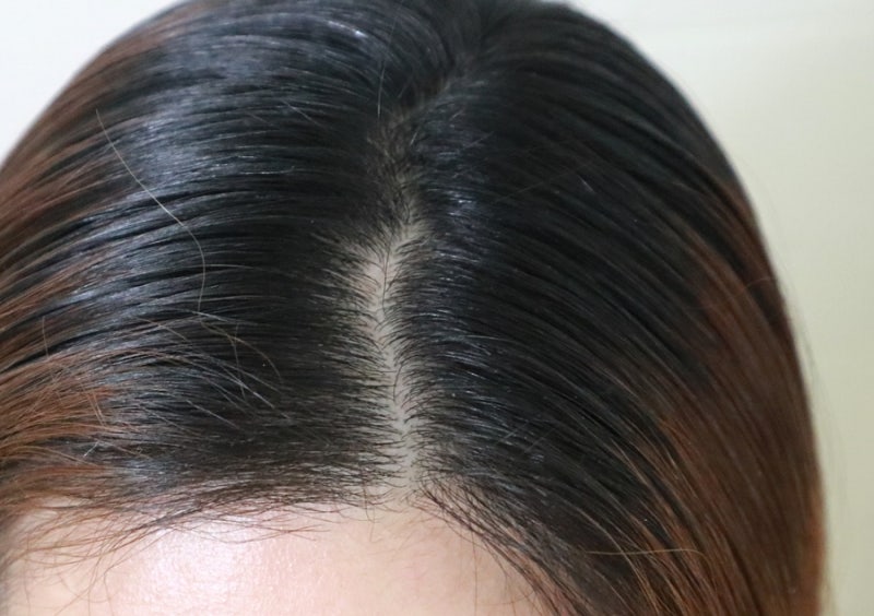 르네휘테르 김서형샴푸 포티샤 두피자신감세트 3주 사용 후 당당해지자 네이버 블로그