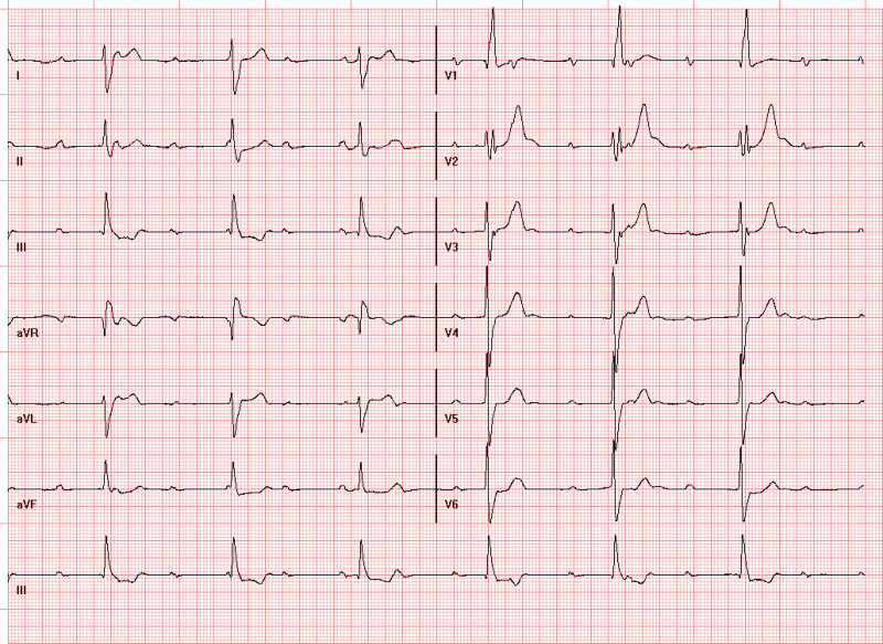 완전 방실 차단(블록), 혈역학적으로 안정한 경우, Third degree (complete) atrioventricular ...