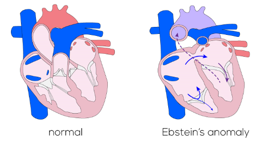 Ebstein's Anomaly (엡스타인 기형) : 네이버 블로그