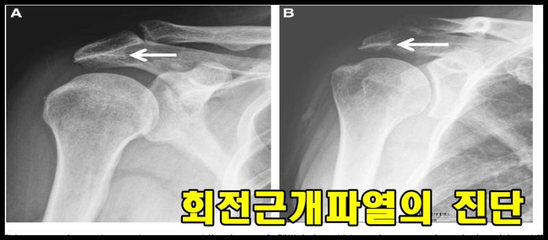 어깨 회전근개파열 산재 사고 불승인 선반 가공 반복 통증 극상근 산재노무사 정시환 네이버 블로그