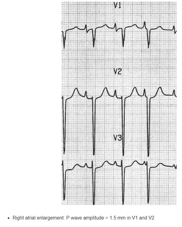 폐성 P, P pulmonale [심전도, EKG(ECG)] : 네이버 블로그