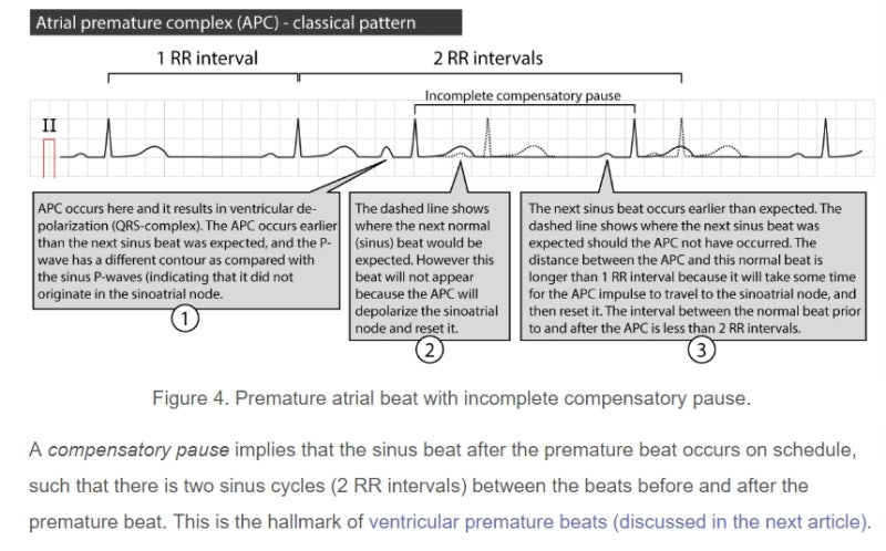 폐성 P, P pulmonale [심전도, EKG(ECG)] : 네이버 블로그