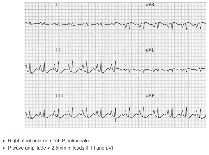 폐성 P, P pulmonale [심전도, EKG(ECG)] : 네이버 블로그