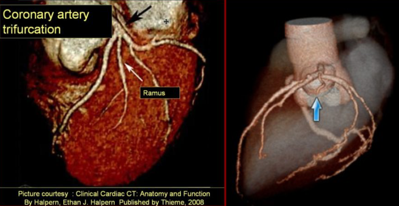 관상동맥 해부 (Coronary Artery Anatomy) : 네이버 블로그