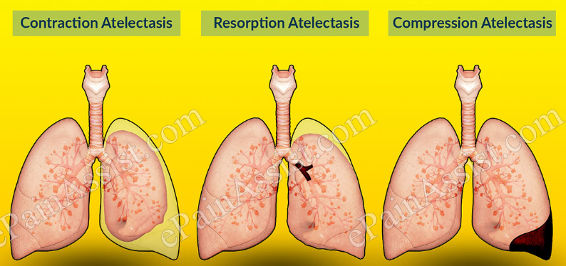 무기폐(atelectasis)란? 흉부 X선(CXR, Chest x-ray) 감별소견 with 흉수(pleural fluid ...