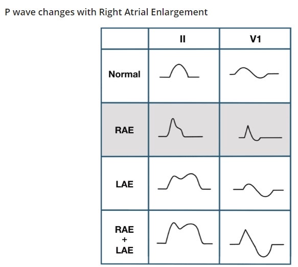 폐성 P, P pulmonale [심전도, EKG(ECG)] : 네이버 블로그