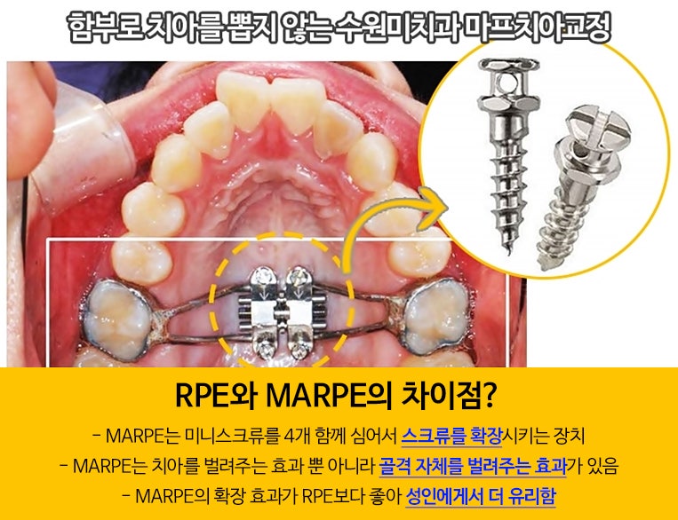 악궁확장장치 MARPE, RPE와는 어떤 차이가 있나요? : 네이버 블로그