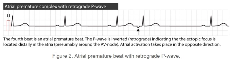 폐성 P, P pulmonale [심전도, EKG(ECG)] : 네이버 블로그