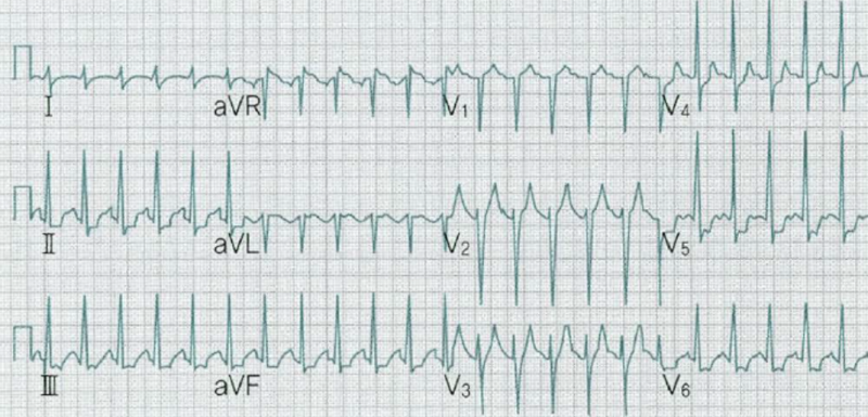 운동부하 심전도 검사(Exercise EKG)와 bruce protocol(브루스 프로토콜) : 네이버 블로그
