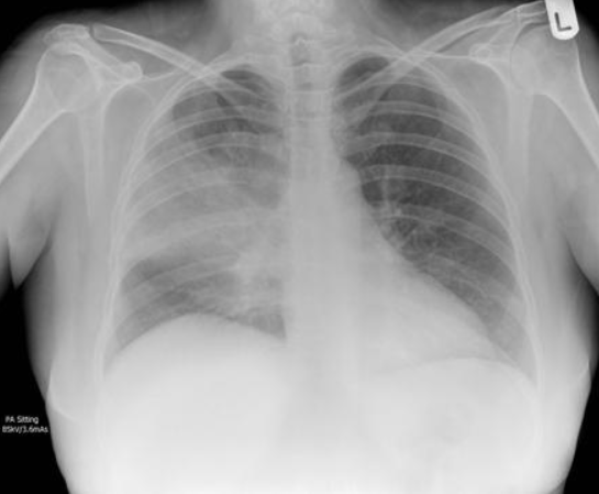 Lobar pneumonia(폐렴)의 흉부 X선 소견(Chest X-ray, CXR): lobar consolidation ...