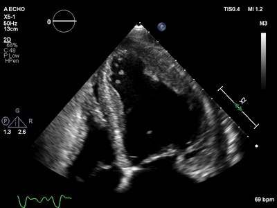 확장성 심근병증(Dilated cardiomyopathy),DCMP : 네이버 블로그