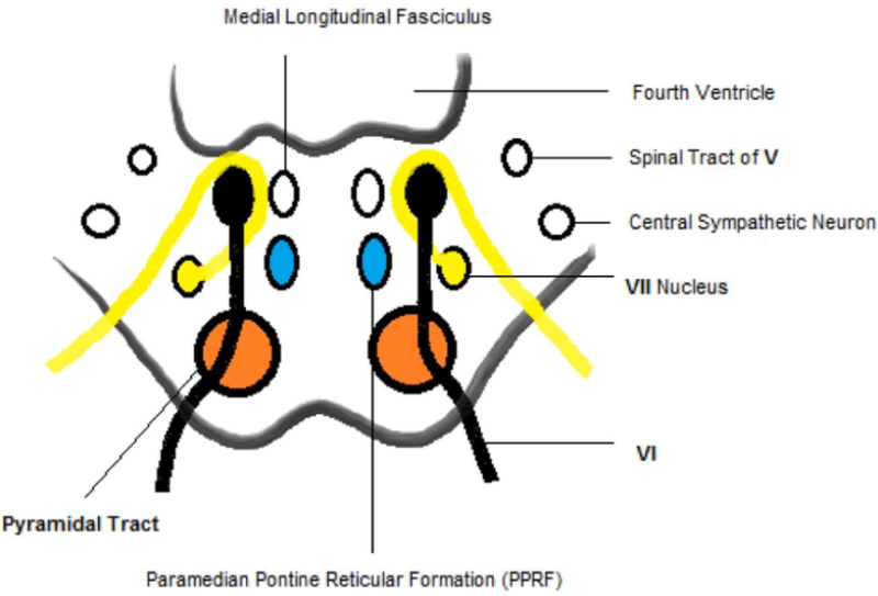 Paramedian Pontine Infarct