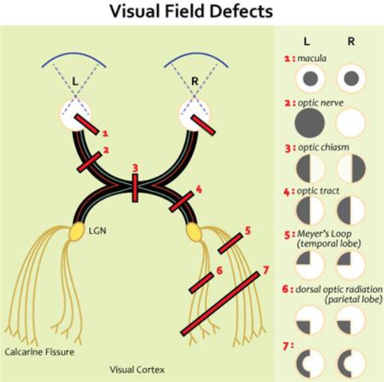 시각로부챗살(optic radiation) : 반대쪽 동측 반맹(contralateral homonymous ...