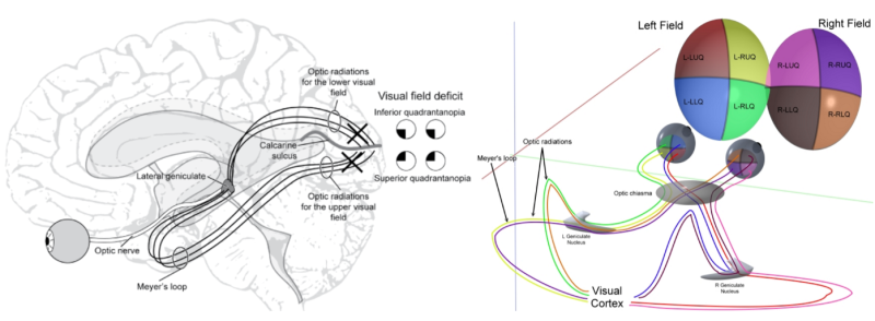 시각로부챗살(optic radiation) : 반대쪽 동측 반맹(contralateral homonymous ...