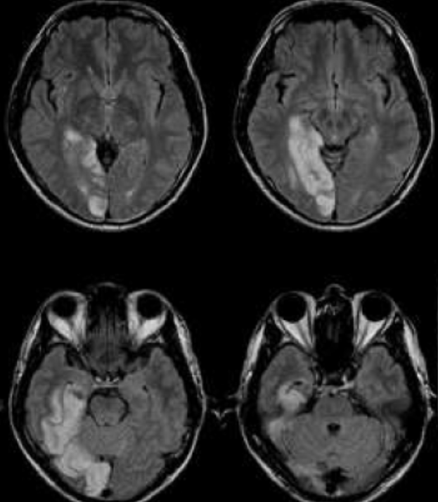 시각로부챗살(optic radiation) : 반대쪽 동측 반맹(contralateral homonymous ...
